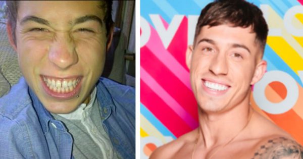 Love Island: The Islanders with the most shocking teeth transformations