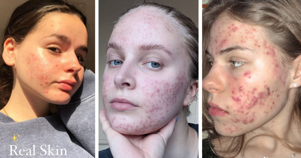 Acne Positivity What Is Acne Positivity And Skin Neutrality