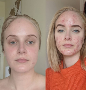 Acne positivity: What is acne positivity and skin neutrality?