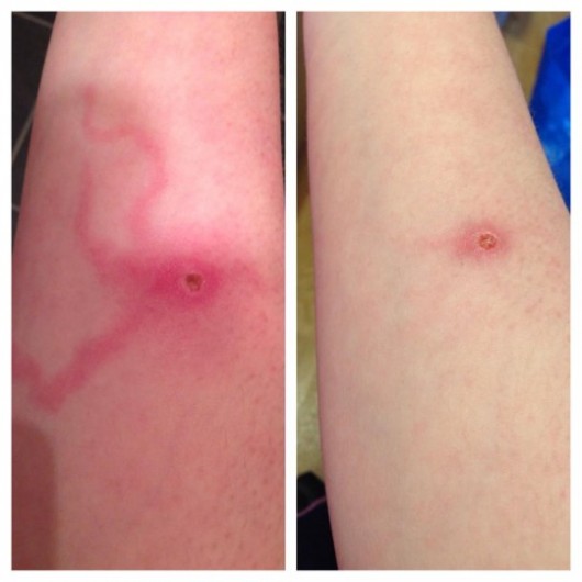 A venomous spider bit me in halls and now I'm scared to sleep